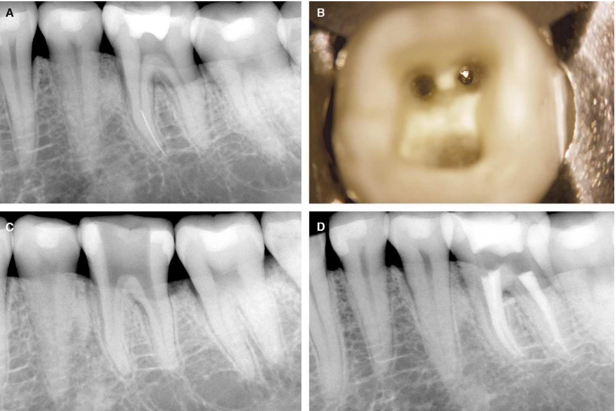 Fic 18. (a) a preoperative film of a mandibular left first