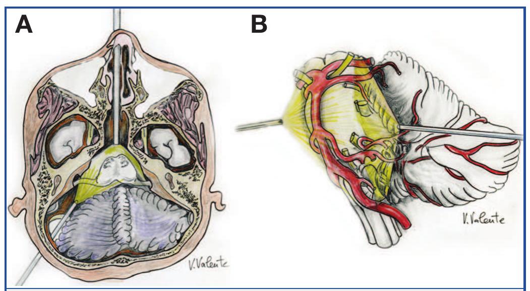 A, schematic drawing showing both endoscopic endonasal