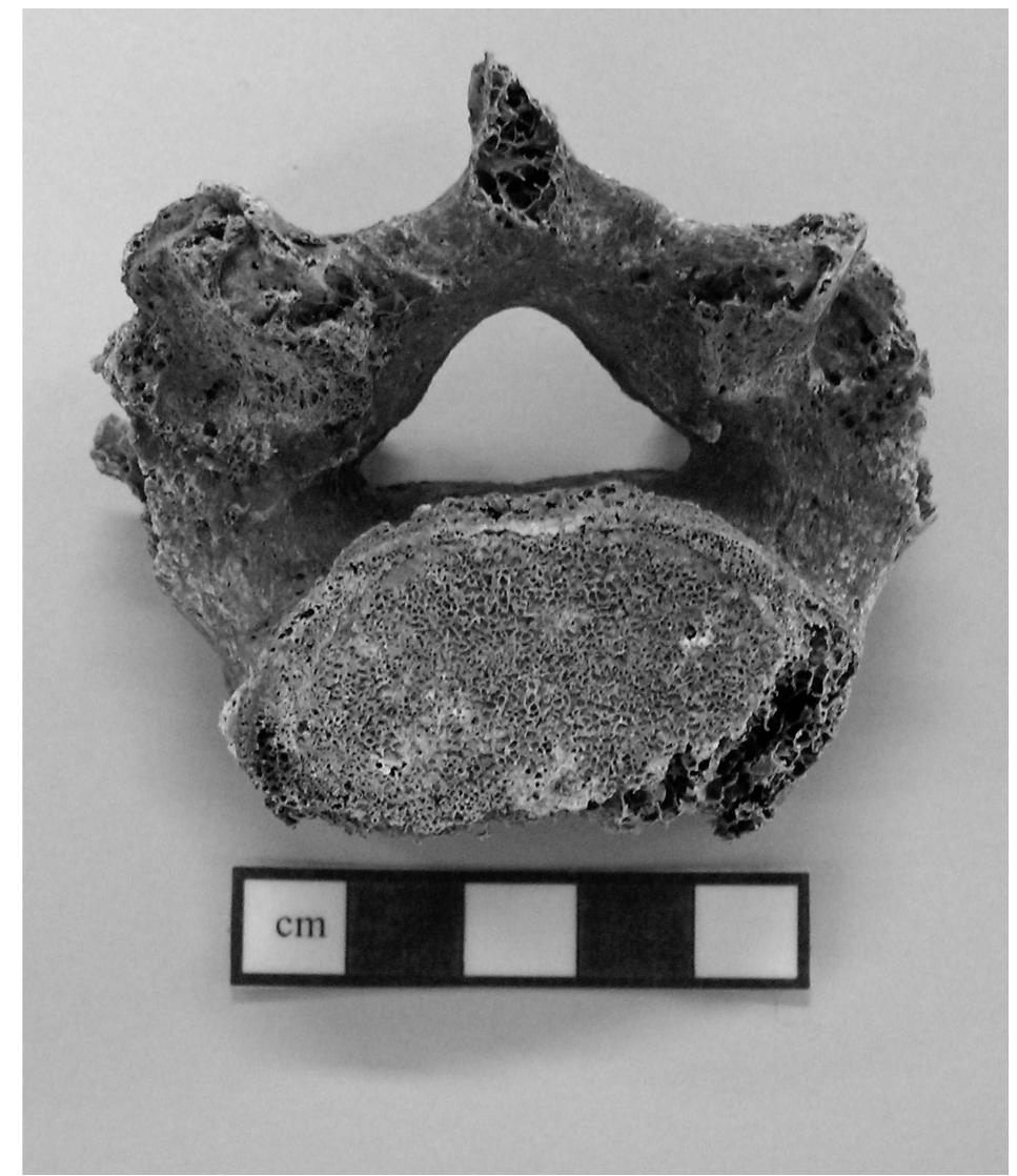 Skeleton 97. osteoarthritis of the spine. osteophytes,