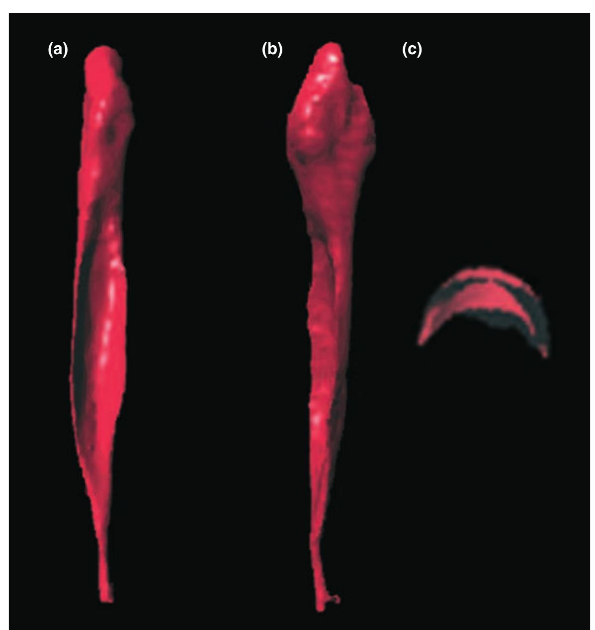 Mandibular left second premolar pulp morphology: (a) buccal