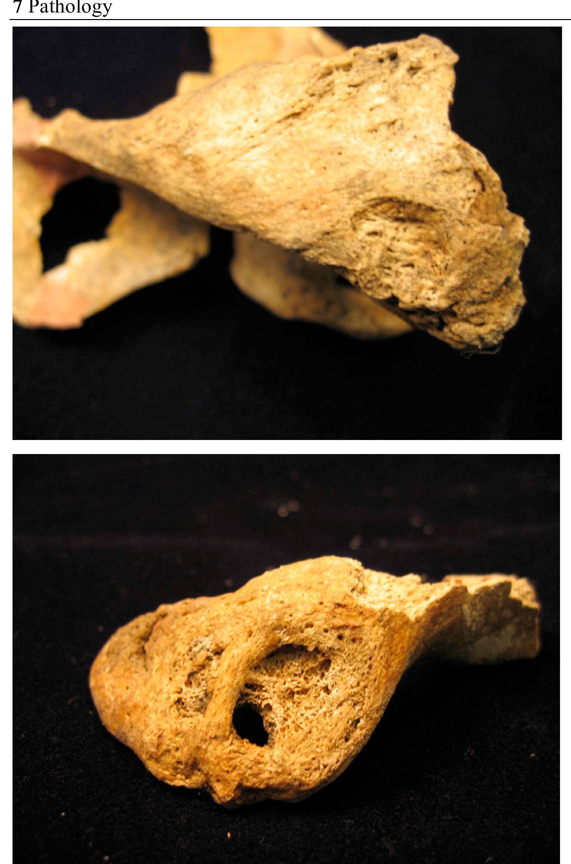 Top;left acromion process of the scapula with lytic lesion