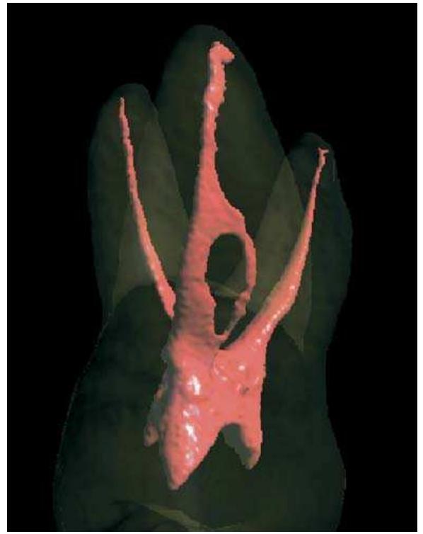 Mesiobuccal view of root canal system of a maxillary first