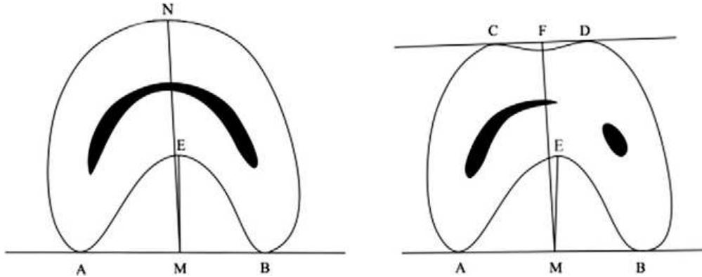 Fic 4. measurement of depth of groove and thickness of root.