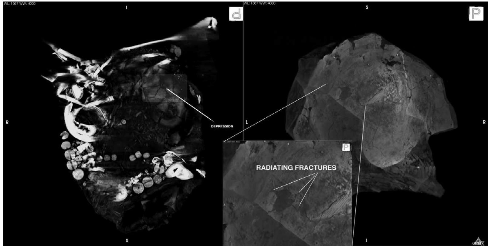 Ct scan images of both skulls showing depressed areas,