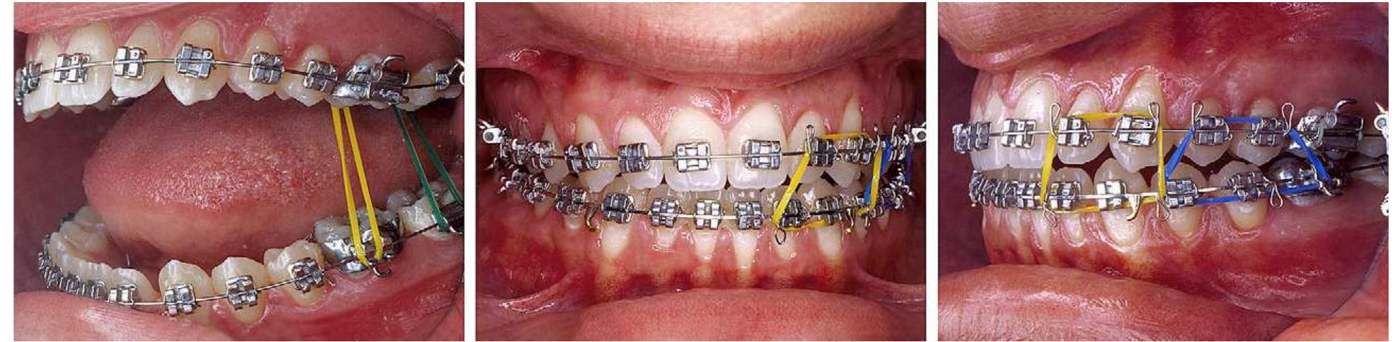 Intraoral progress photographs show the use of