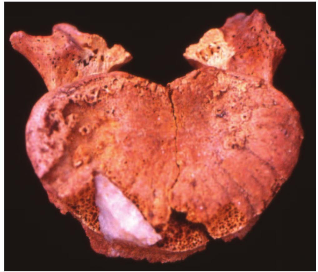 3. human vertebrae with lithic point. (bernardo arriaza)