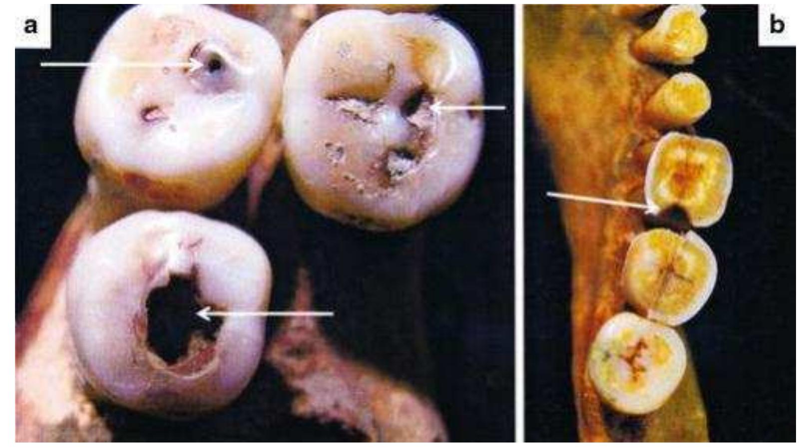 Carious lesions noted by arrows. (a) coronal; (b)