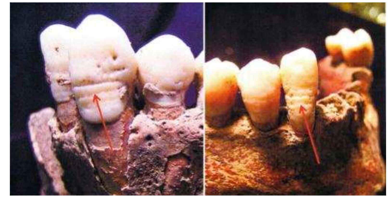 Well developed linear enamel hypoplasia on upper and lower