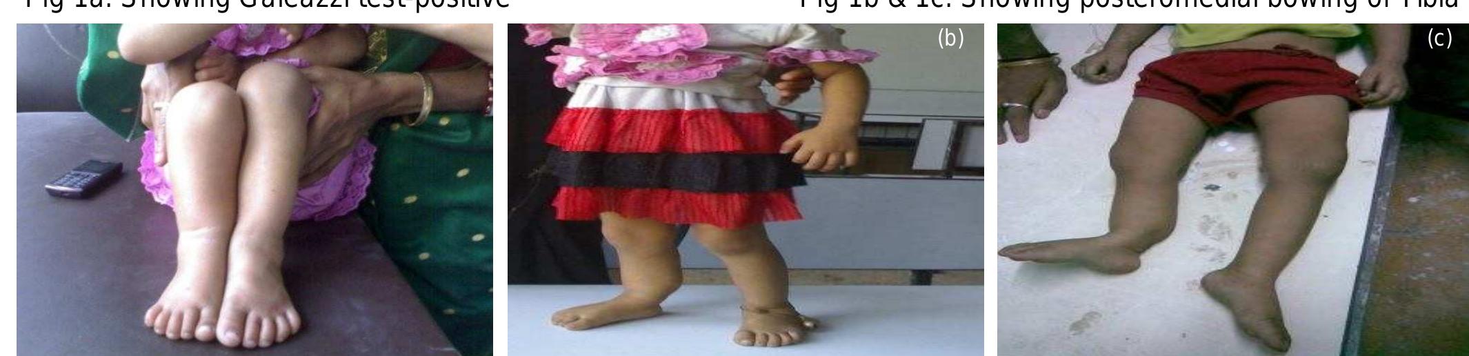 Showing anterior, posterior and lateral view of orthosis