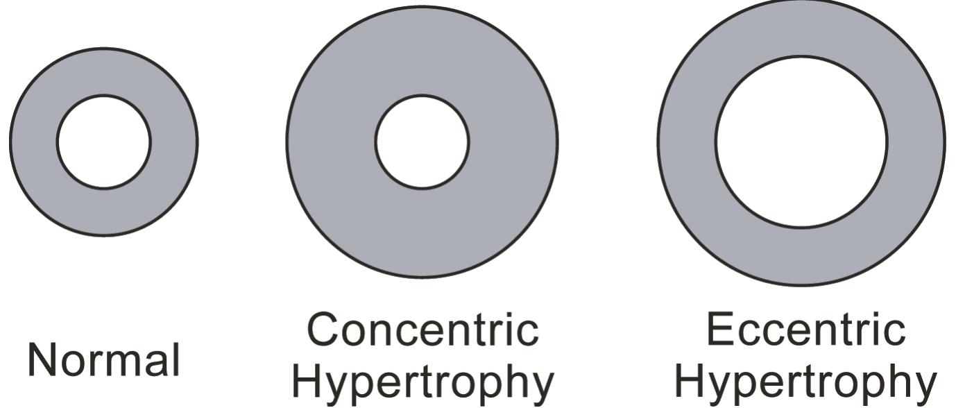 Concentric versus eccentric ventricular hypertrophy. with
