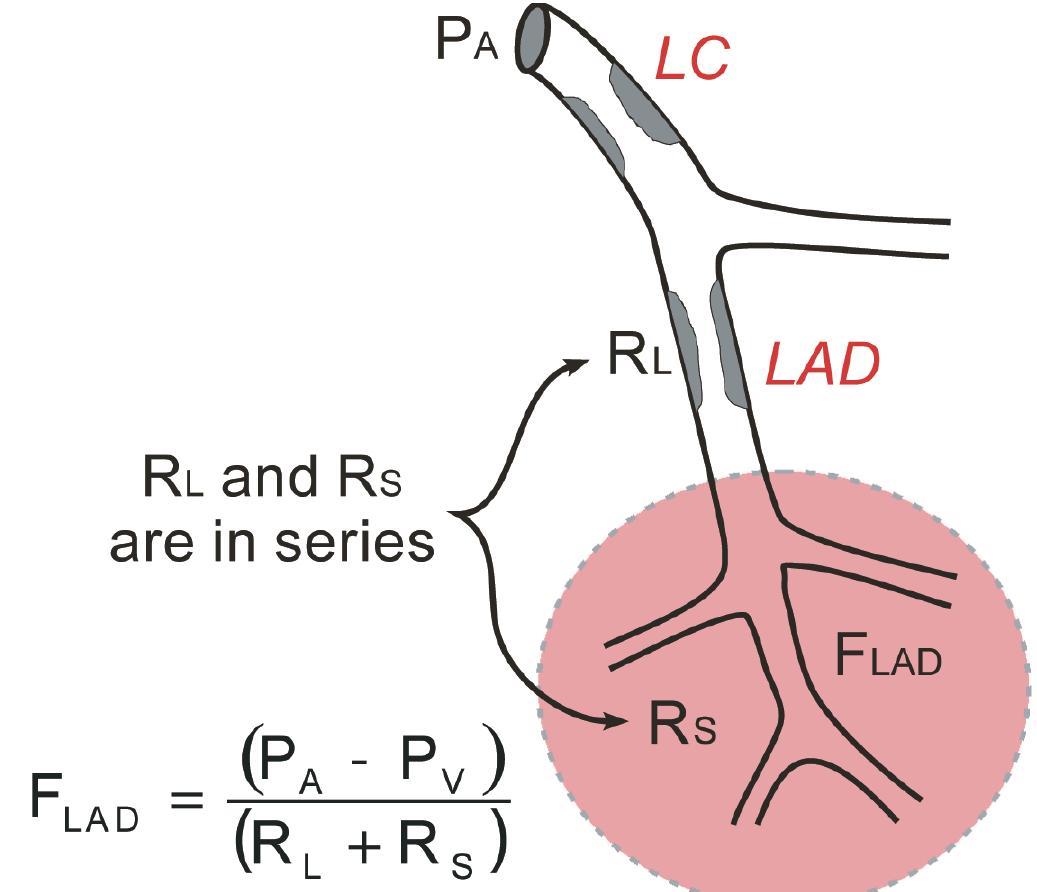 Model of the coronary circulation showing a stenotic left