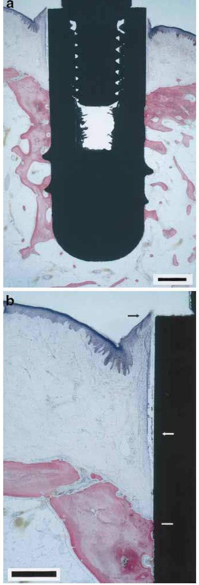 A. mesio-distal section (overview) of a type a implant