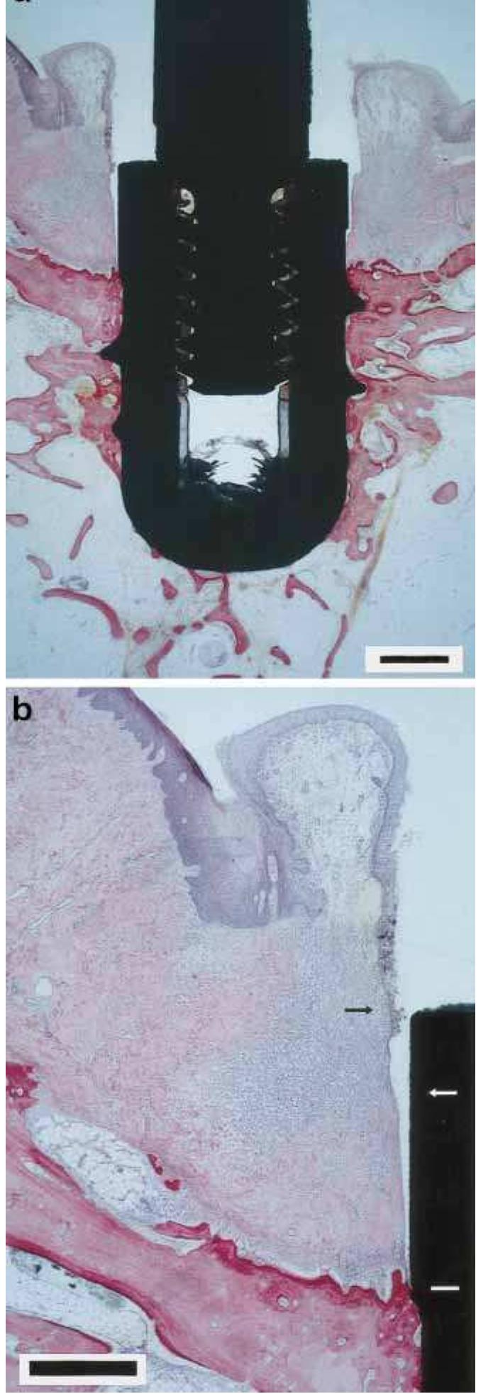A. mesio-distal section (overview) of a type d implant