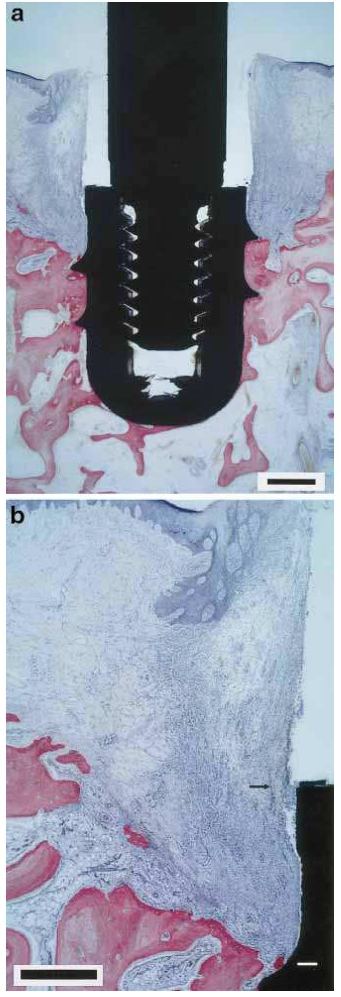 A. mesio-distal section (overview) of a type f implant