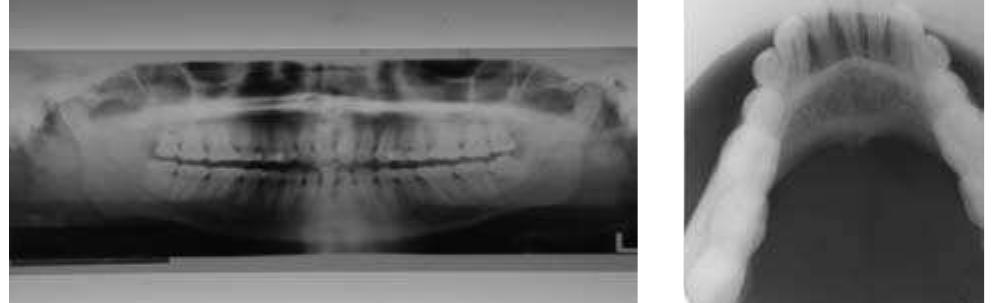 Opg and mandibular occlusal view after removal of