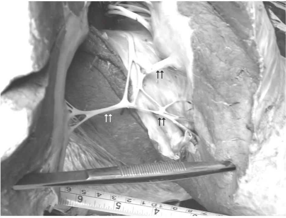 The interior of the left ventricle showing a left