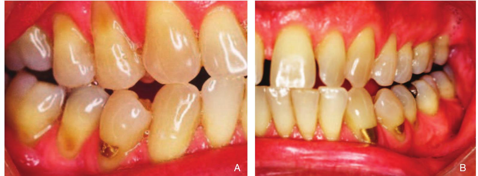 A, multifactorial noncarious cervical lesions in both upper