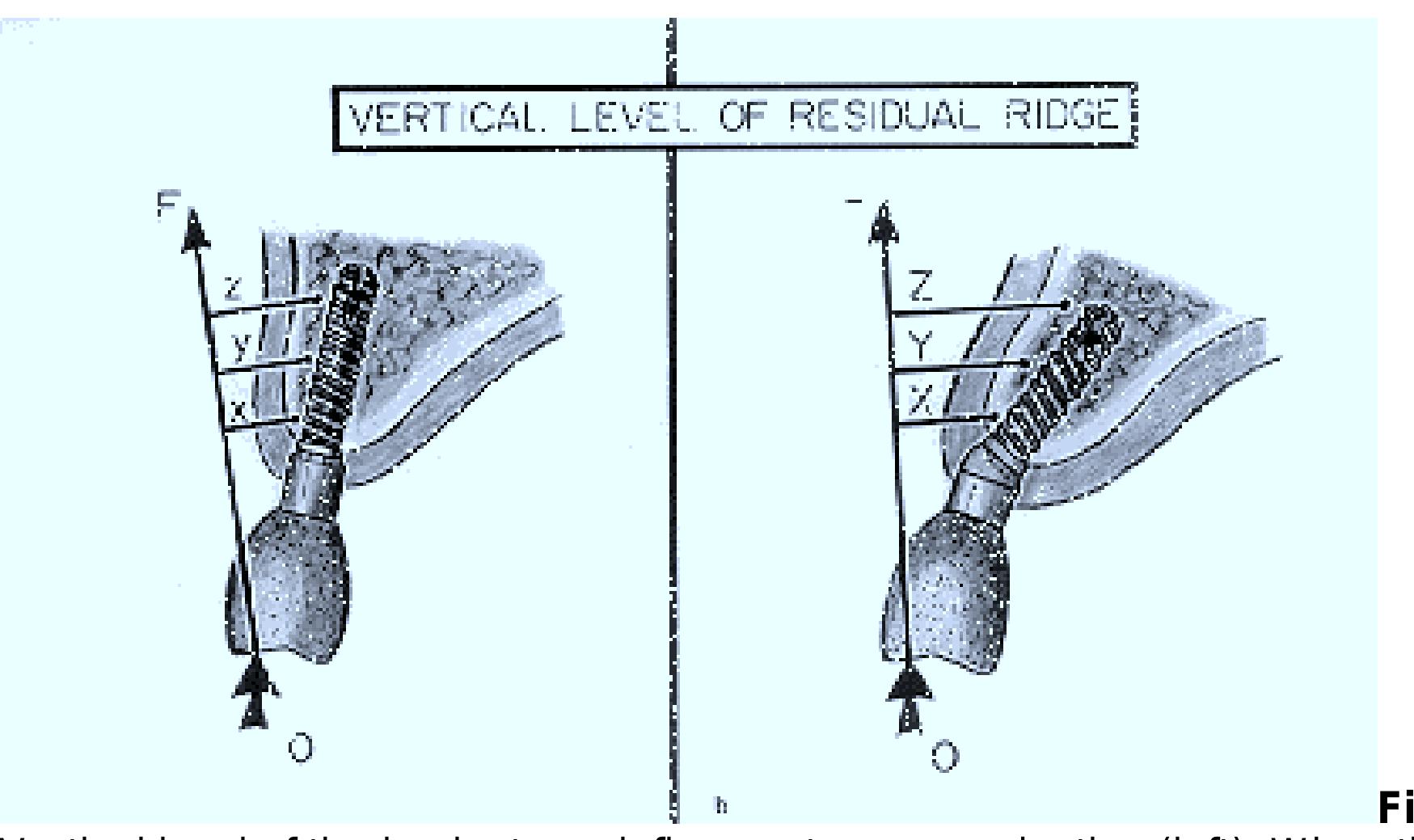 (posterior cross bite, right). o = vertical occlusal force;