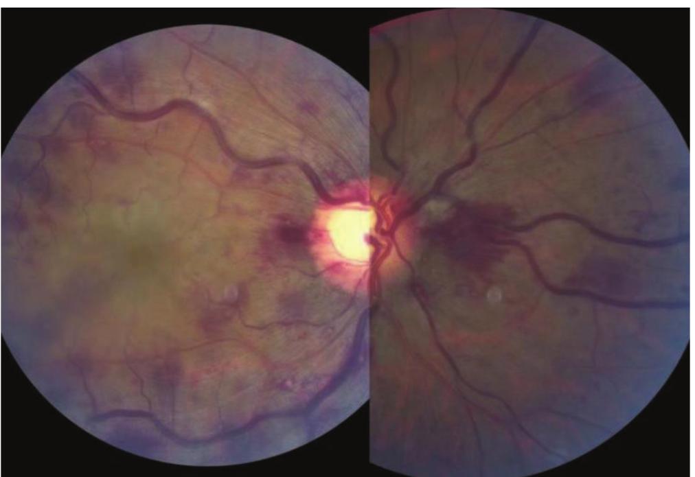 |. color fundus photograph of the right eye showed