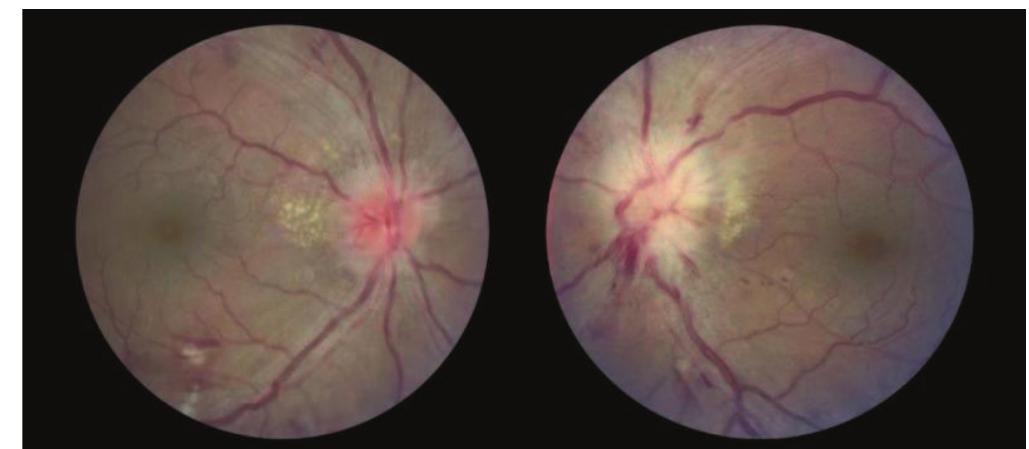 An example of acute hypertensive retinopathy, which is one