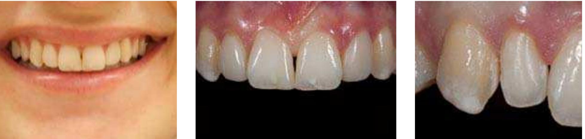 Intraoral view, showing the fracture on tooth 12, damage on