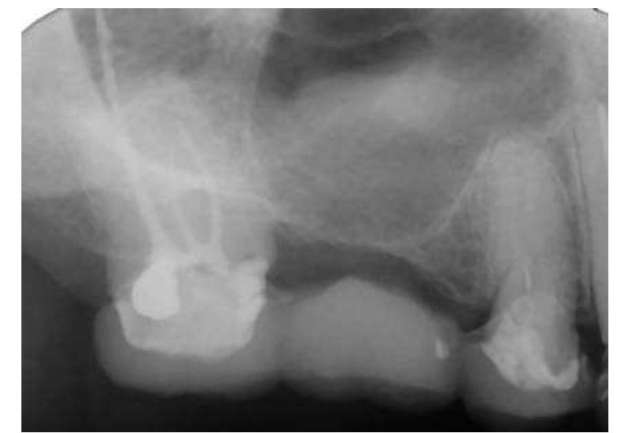 22 root canal treatment has been attempted on both abutments