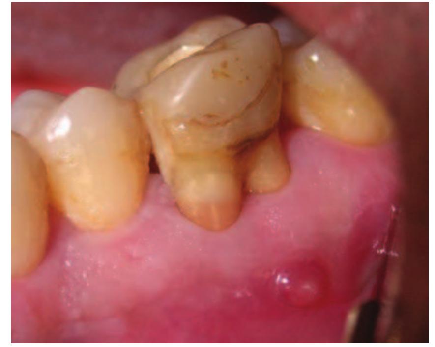 33 this mandibular molar presented with a buccal sinus tract