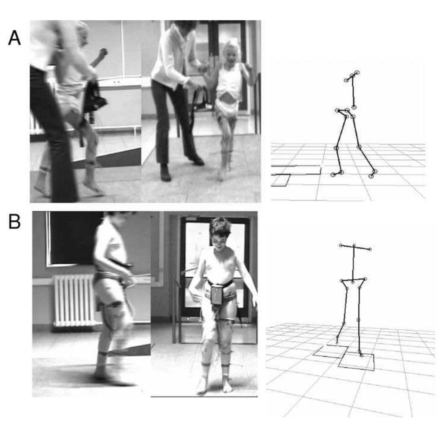 1 walking patterns in angelman syndrome recorded in a