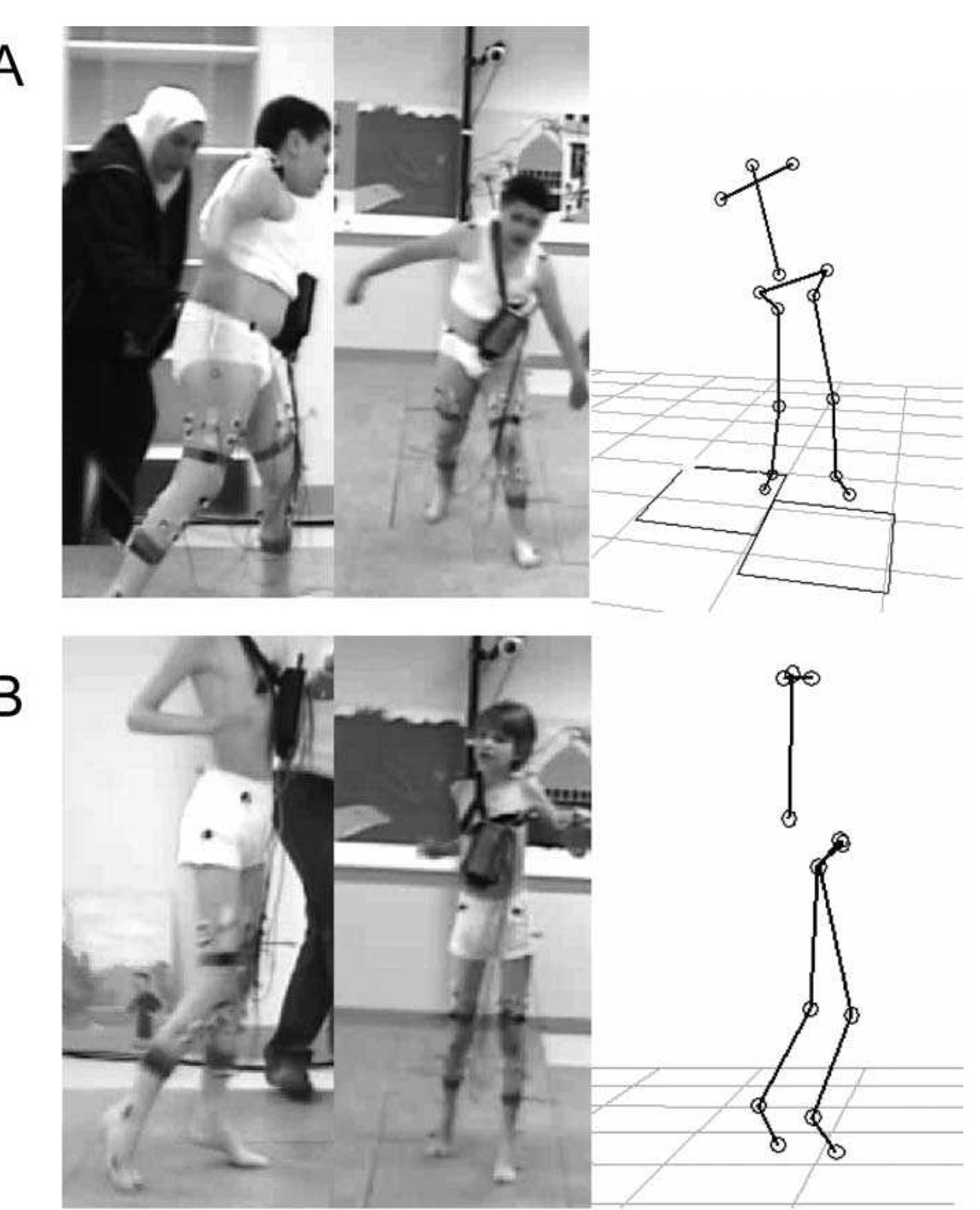 3 walking patterns in rett syndrome recorded in a movement