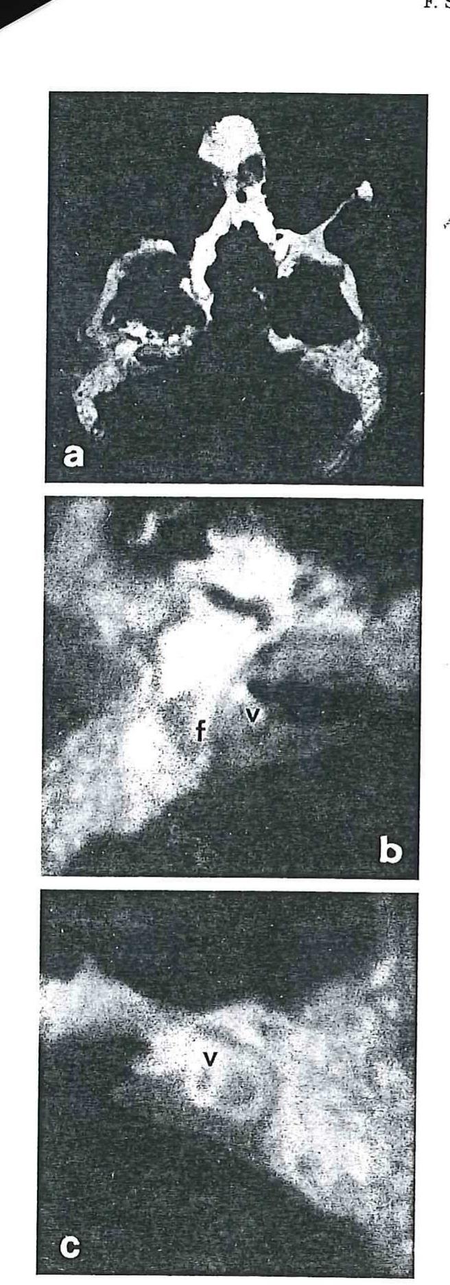 A: transverse overview ct scan at the level indicated in