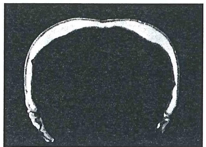 Coronal ct scans of the singa calvaria at the level of