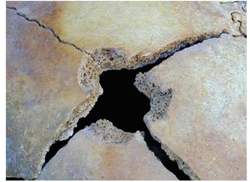 Bone, trauma in, fig. 11 gunshot exit wound. note the