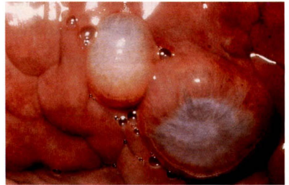 71 endoscopic view of a large and a small endometrial cyst