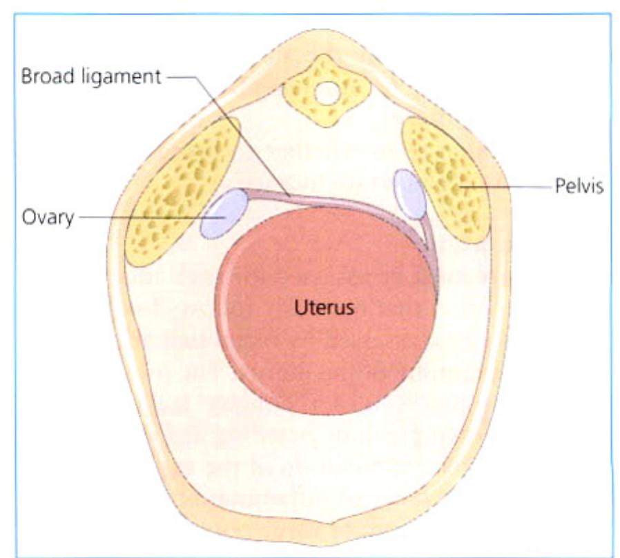 23 uterine torsion. the broad ligament on the side to which