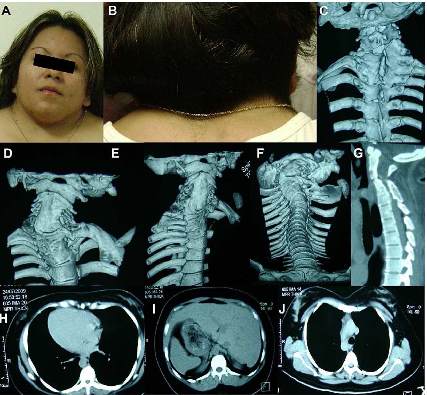 Clinical pictures and cts from a patient with kfs and situs