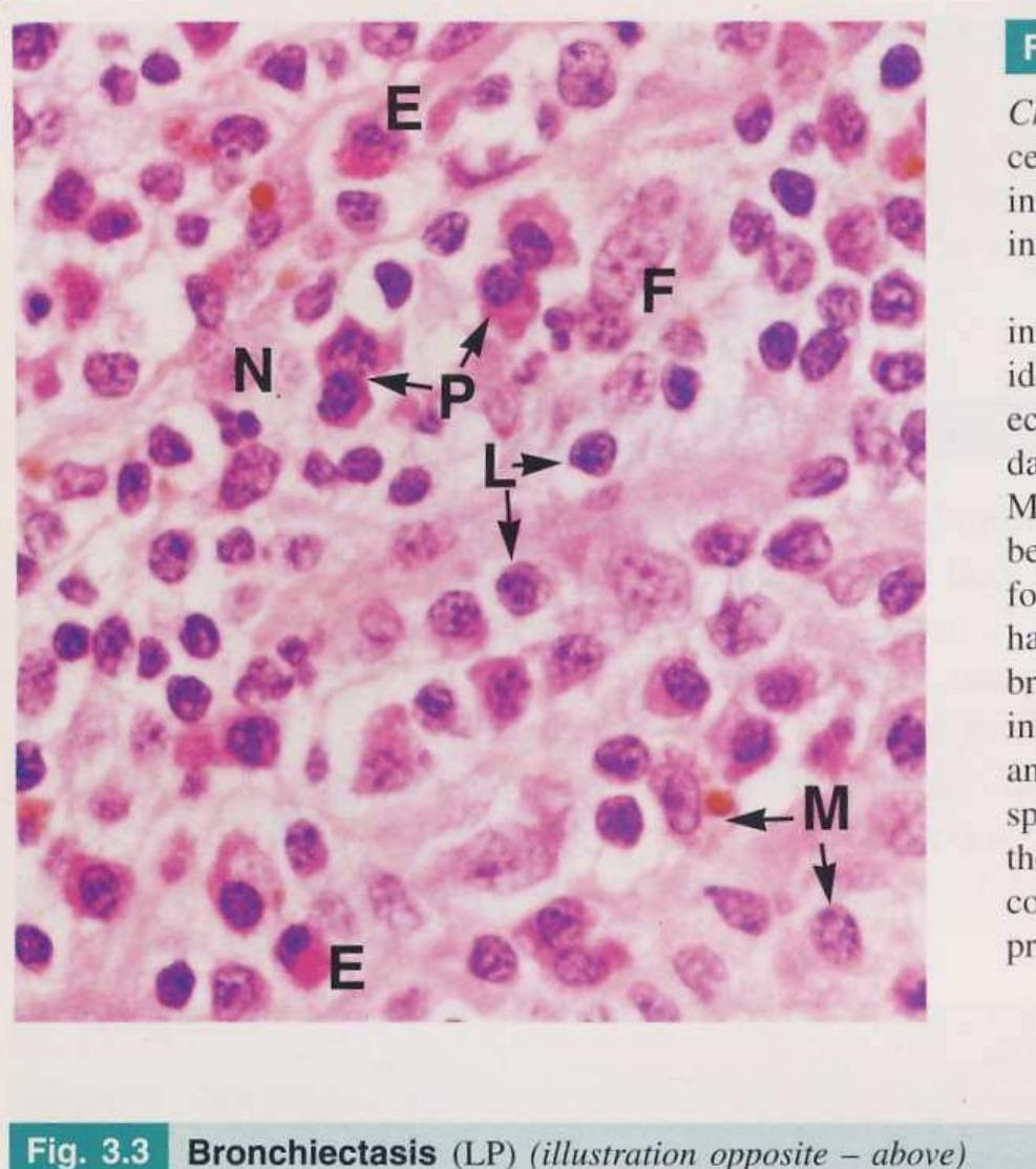 Bronchiectasis is a chronic inflammation of the bronchi