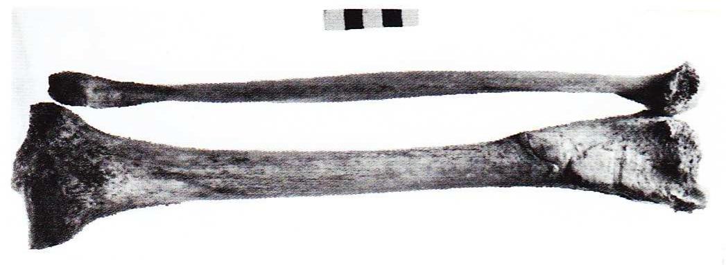 Healed fractures of tibia and fibula from armenoi, tomb 89.