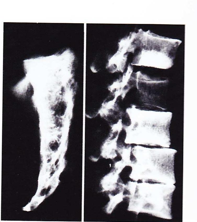 Sacrum and lumbar vertebrae from armenoi tomb 103 a. cause