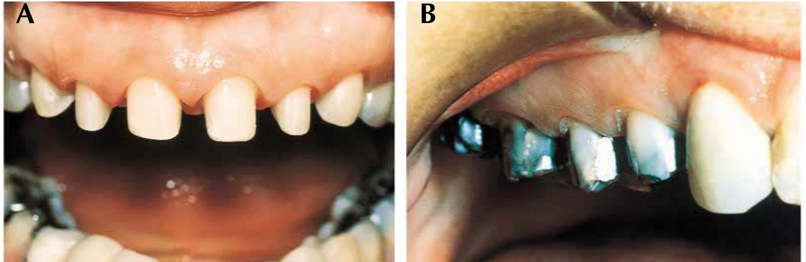 A, maxillary 6 anterior teeth prepared for metal-ceramic