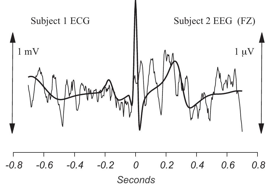 This graph is an overlay plot of the same eeg and ecg data