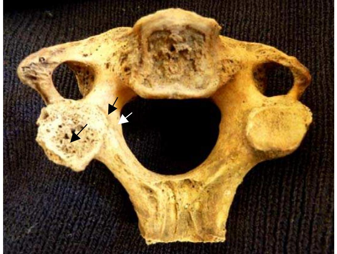 Sk16, cervical vertebrae (inferior view) with eburnation,