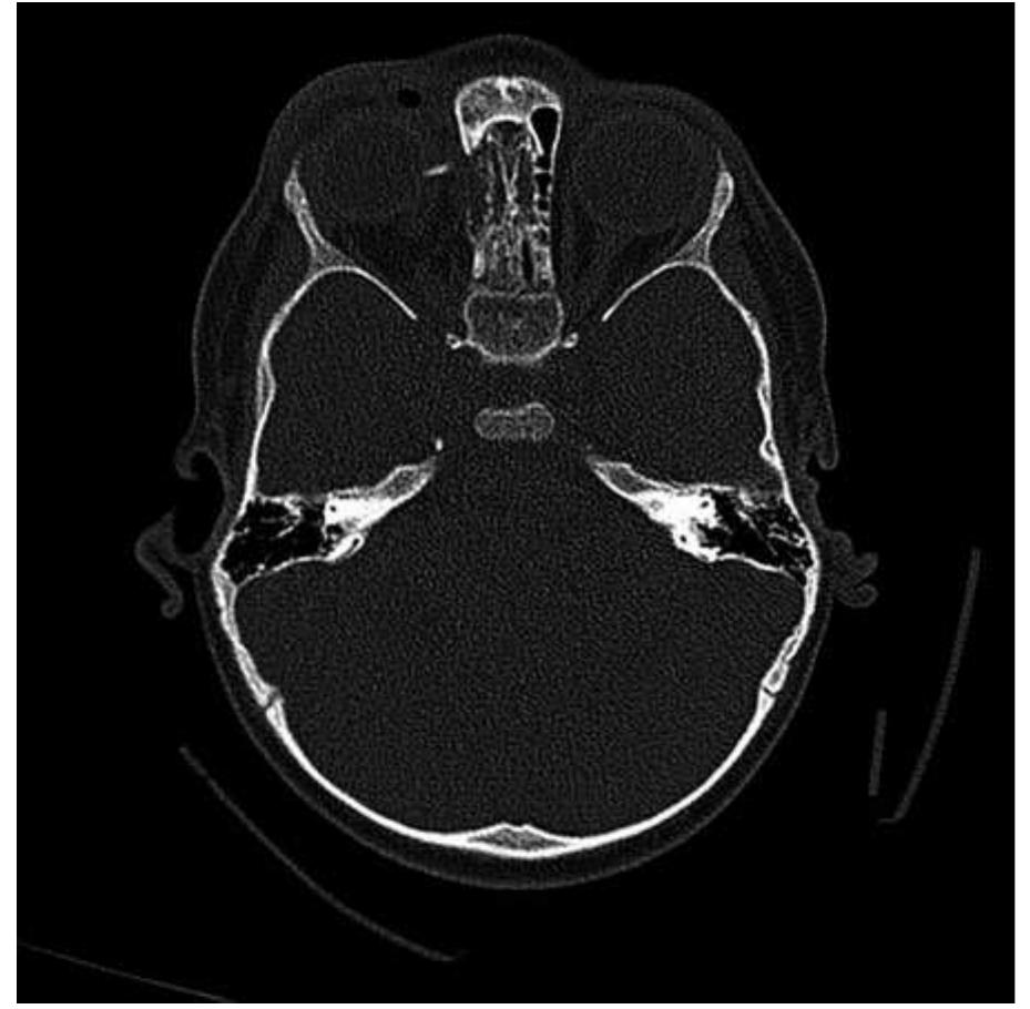 5 another axial bone window view now showing a bone fragment