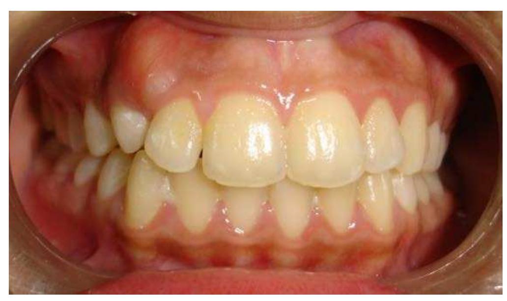 Frontal-intraoral view showing ectopic eruption of maxillary