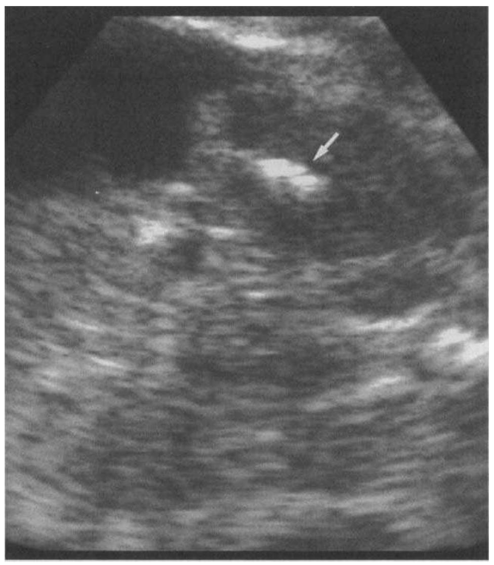 -7. prostatic carcinoma. sagittal-view sonogram of the