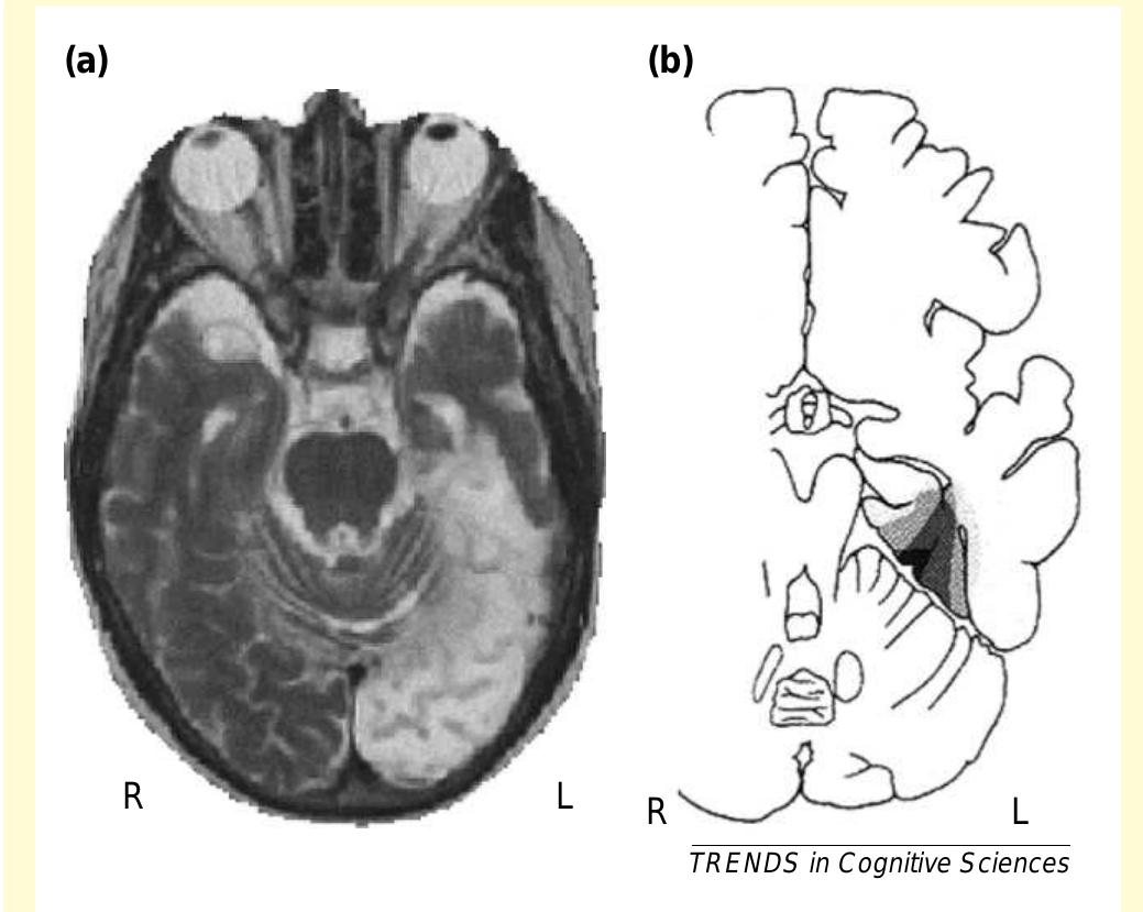 I. extent and location of left posterior lesions are related