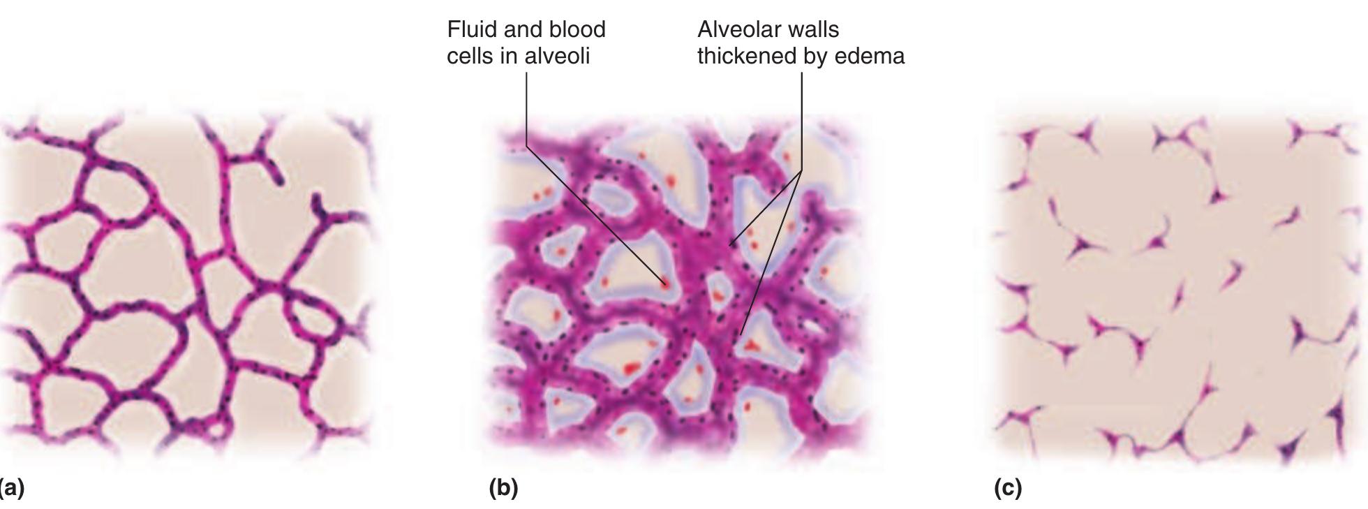 20 influences on gas exchange: (a) normal alveoli, (b)