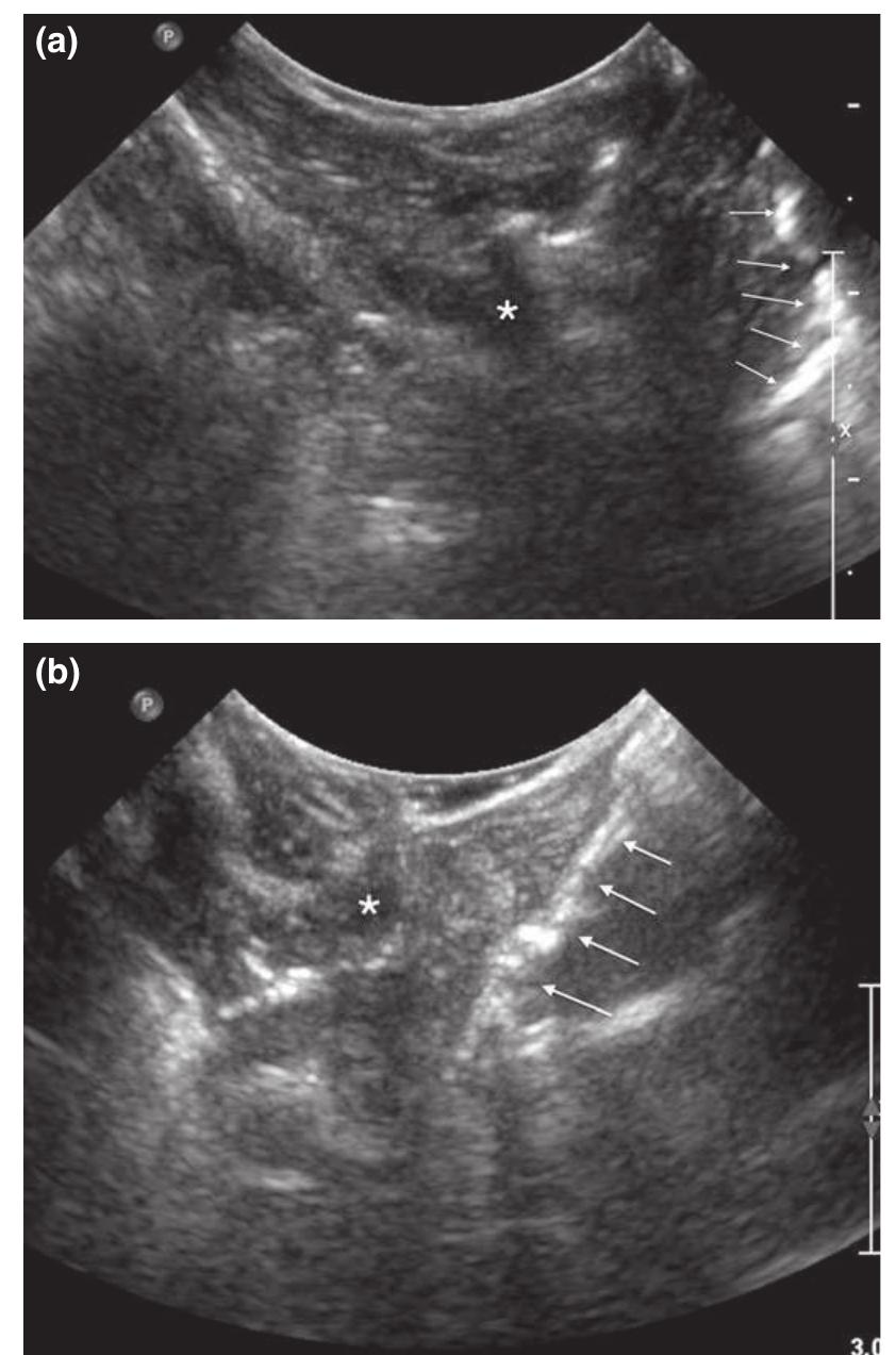 Gray-scale image of the brachial plexus area with the nerve