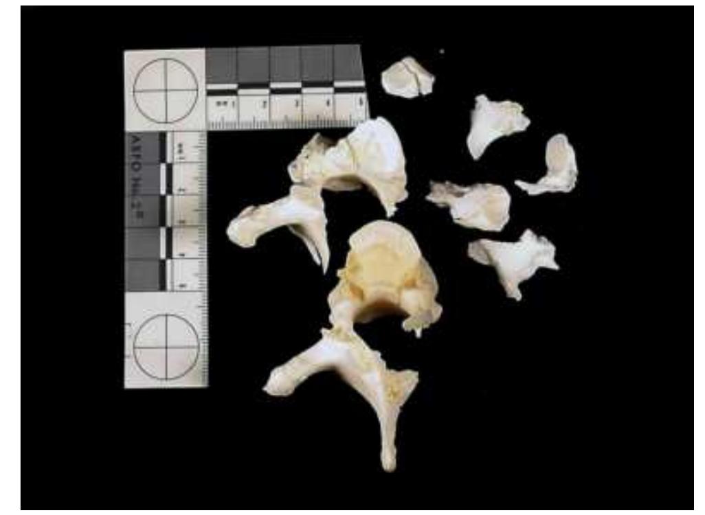—thoracic vertebrae 3, 4, and 5. bullet entered intercostal