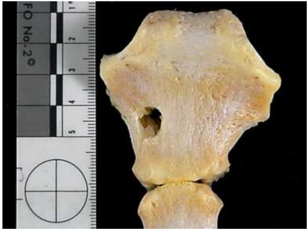 —entrance defect on ventral manubrium. note the depressed