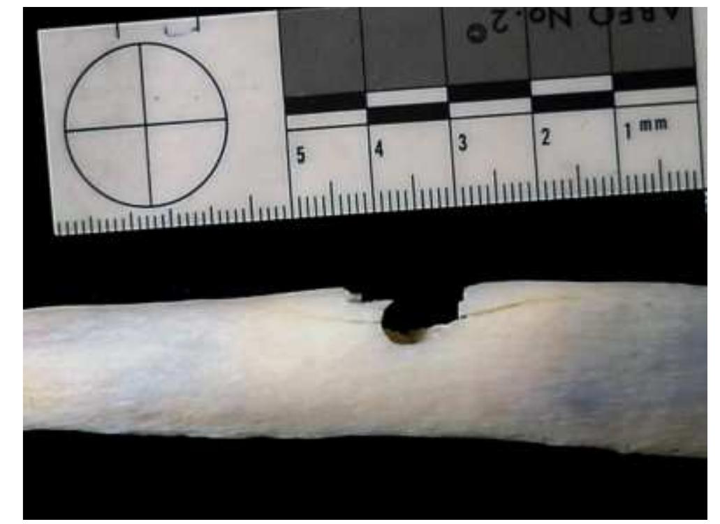 —entrance defect on left rib 7. a 0.25 caliber automatic
